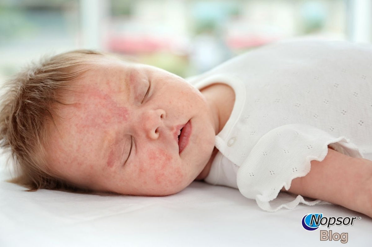 Baby Psoriasis: Understanding the Condition and Treatment Options ...