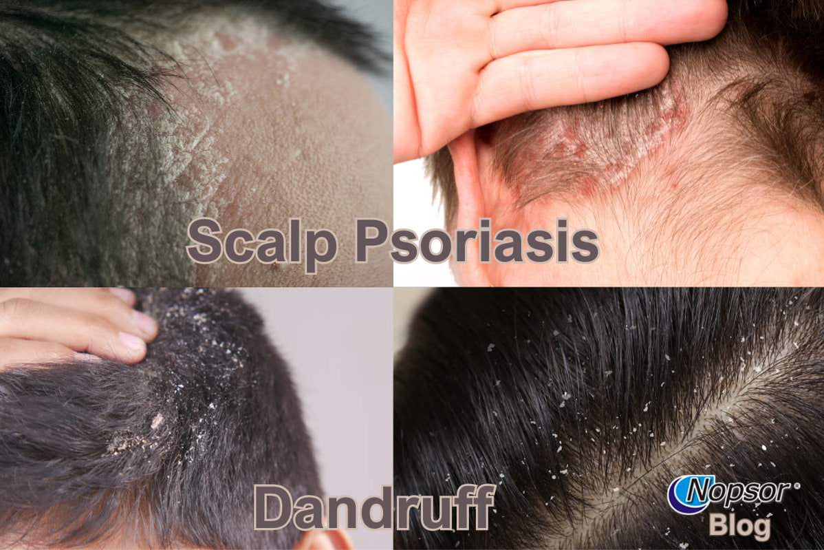 Visual Guide: What Dandruff and Dry Scalp Look Like - Nopsor USA