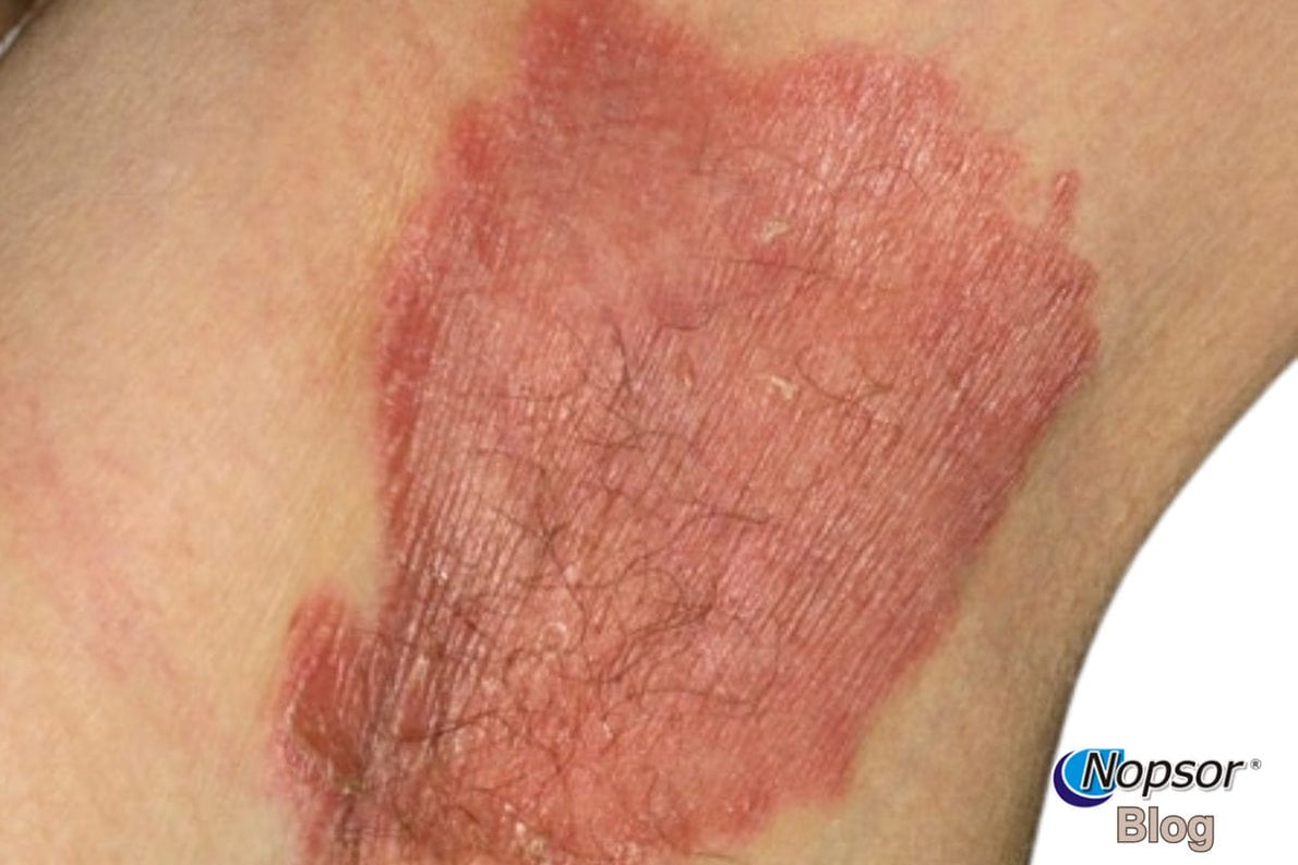 Inverse Psoriasis: Causes, Symptoms, and Best Treatments - Nopsor USA