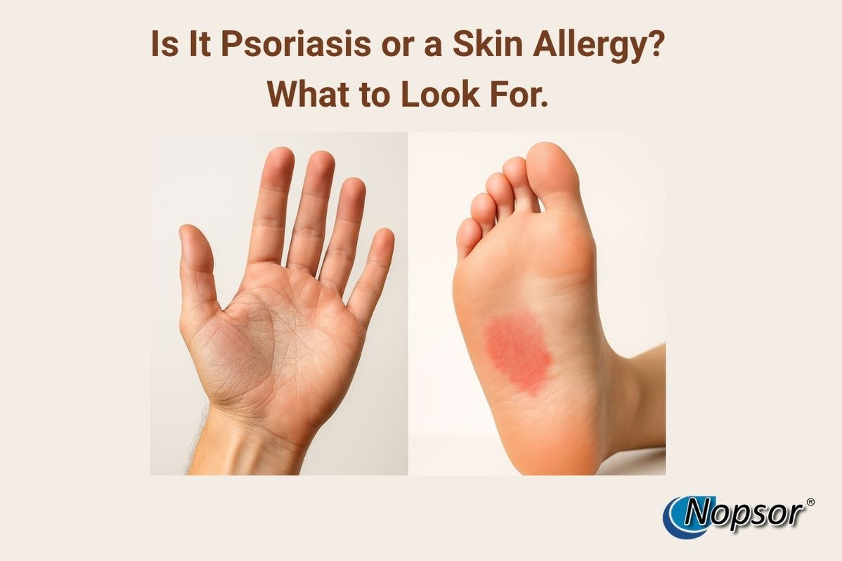 Psoriasis or Eczema? How to Tell the Difference on Hands and Feet - Nopsor USA